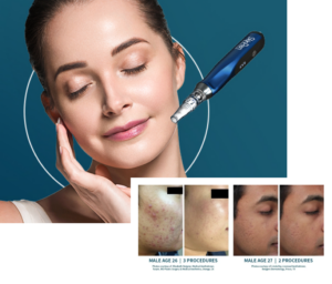 Acne, Redness & Spider Veins | Still Waters Pensacola